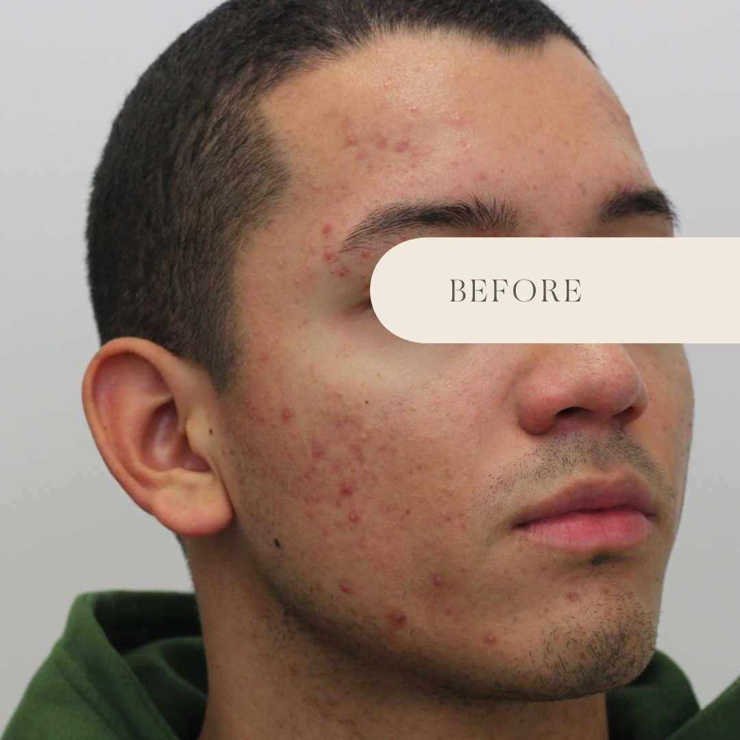 ML Aesthetic Clinic - Holistic MedSpa Specialized in Acne in Montreal